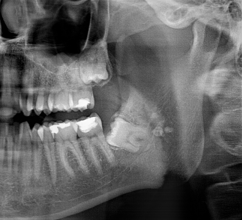 Poluimpaktirani/impaktirani treći molari (umnjaci) – Stomatološka ...